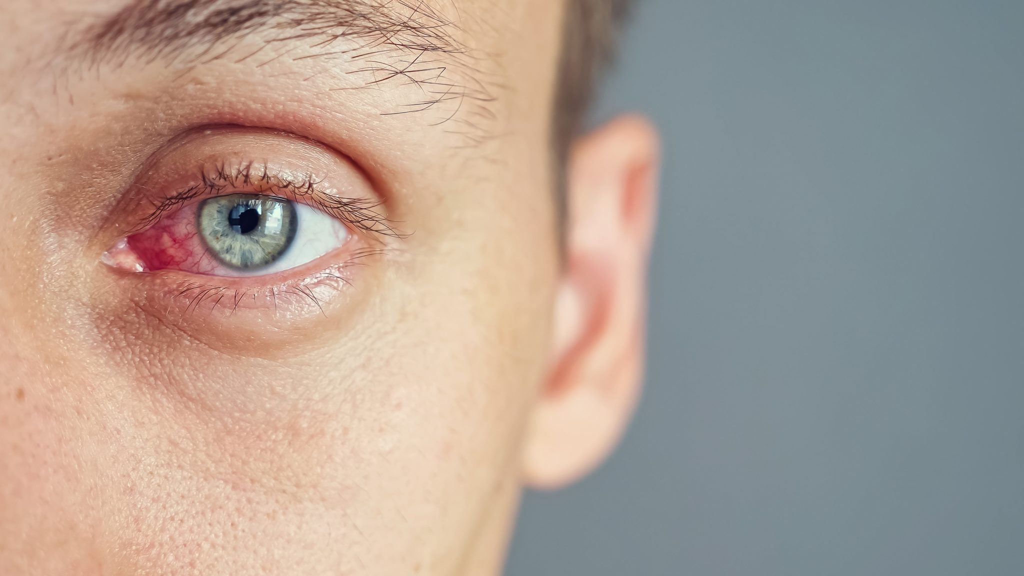 Eyelid Edema: Causes, Symptoms, and Treatments – sightconnection
