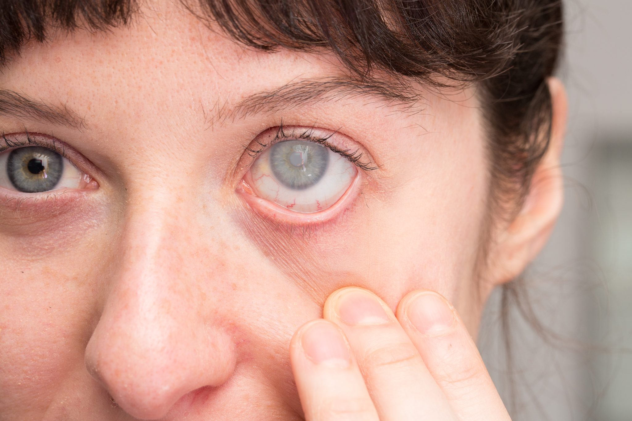Corneal Ulcer: Causes, Symptoms, and Treatment Options – sightconnection