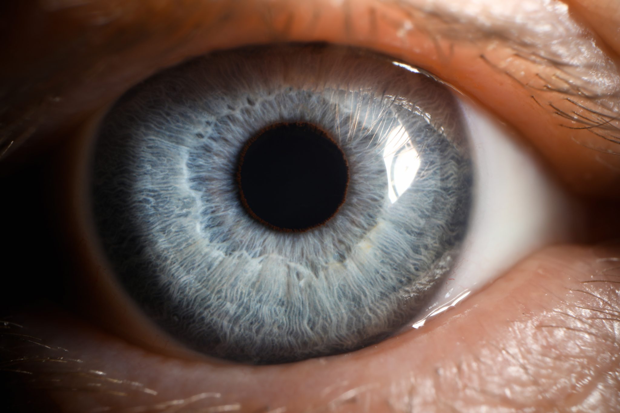 Exploring Arcus Senilis (Corneal Arcus): White Rings Around the Eyes ...
