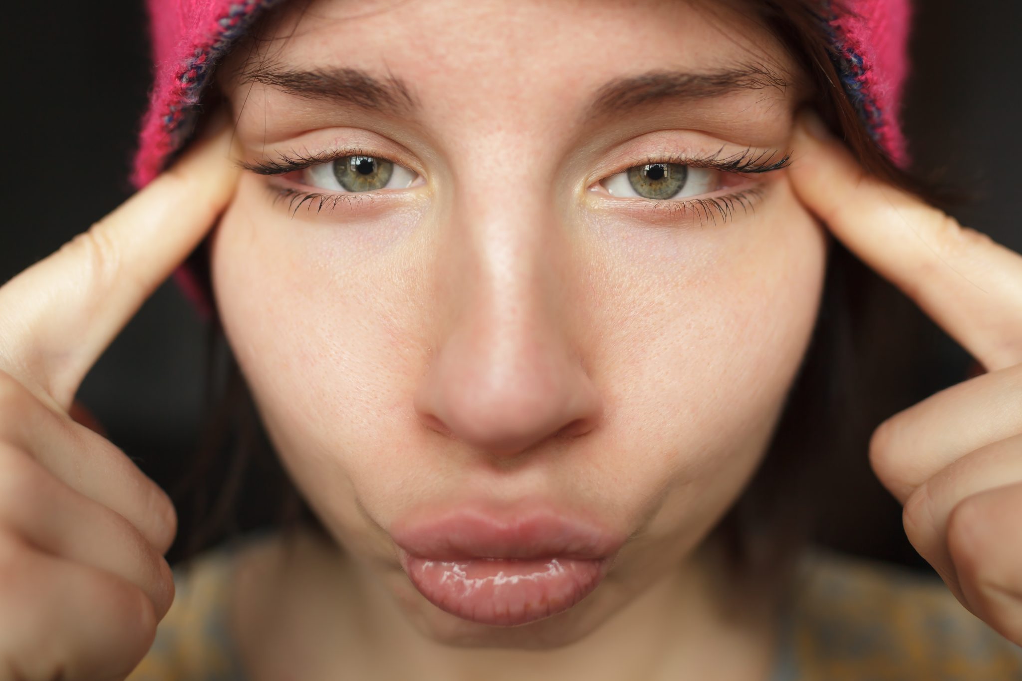 Unraveling the Mystery of Floppy Eyelid Syndrome – sightconnection