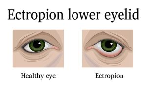 What Are the 4 Types of Entropion – sightconnection